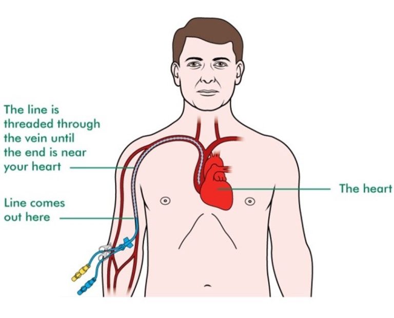 Peripherally inserted central catheter (PICC) line - The Dudley Group ...