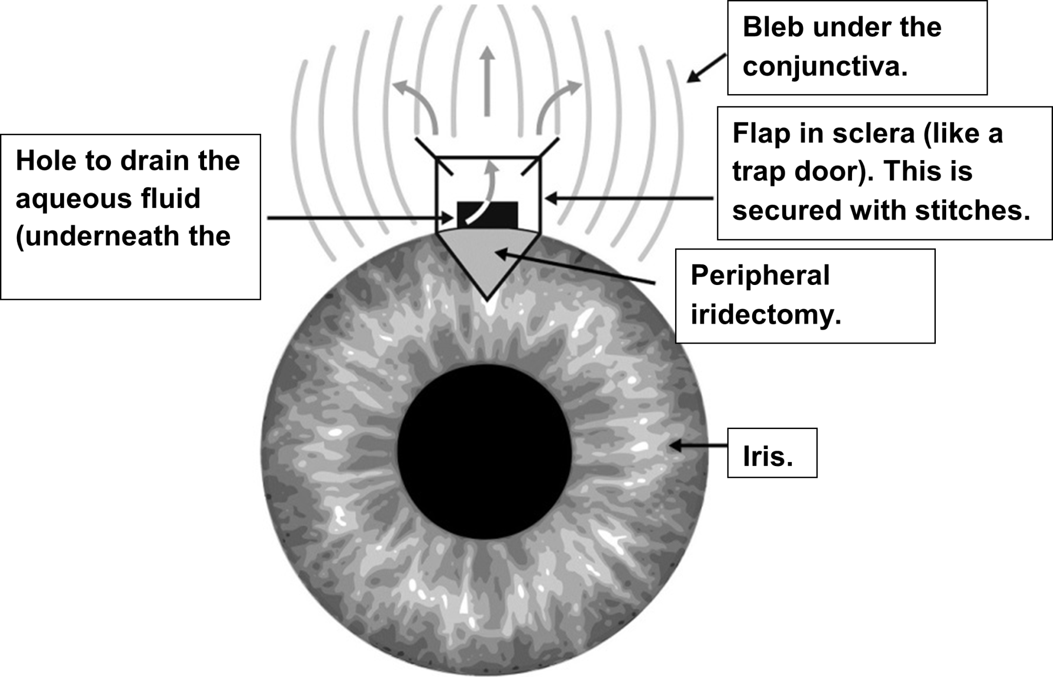 Glaucoma drainage surgery (trabeculectomy) - The Dudley Group NHS ...