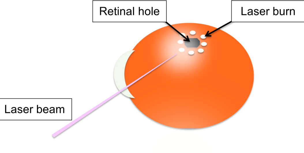 Argon laser retinopexy (photocoagulation) for retinal tear / break ...
