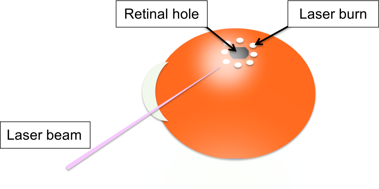 Argon laser retinopexy (photocoagulation) for retinal tear / break ...