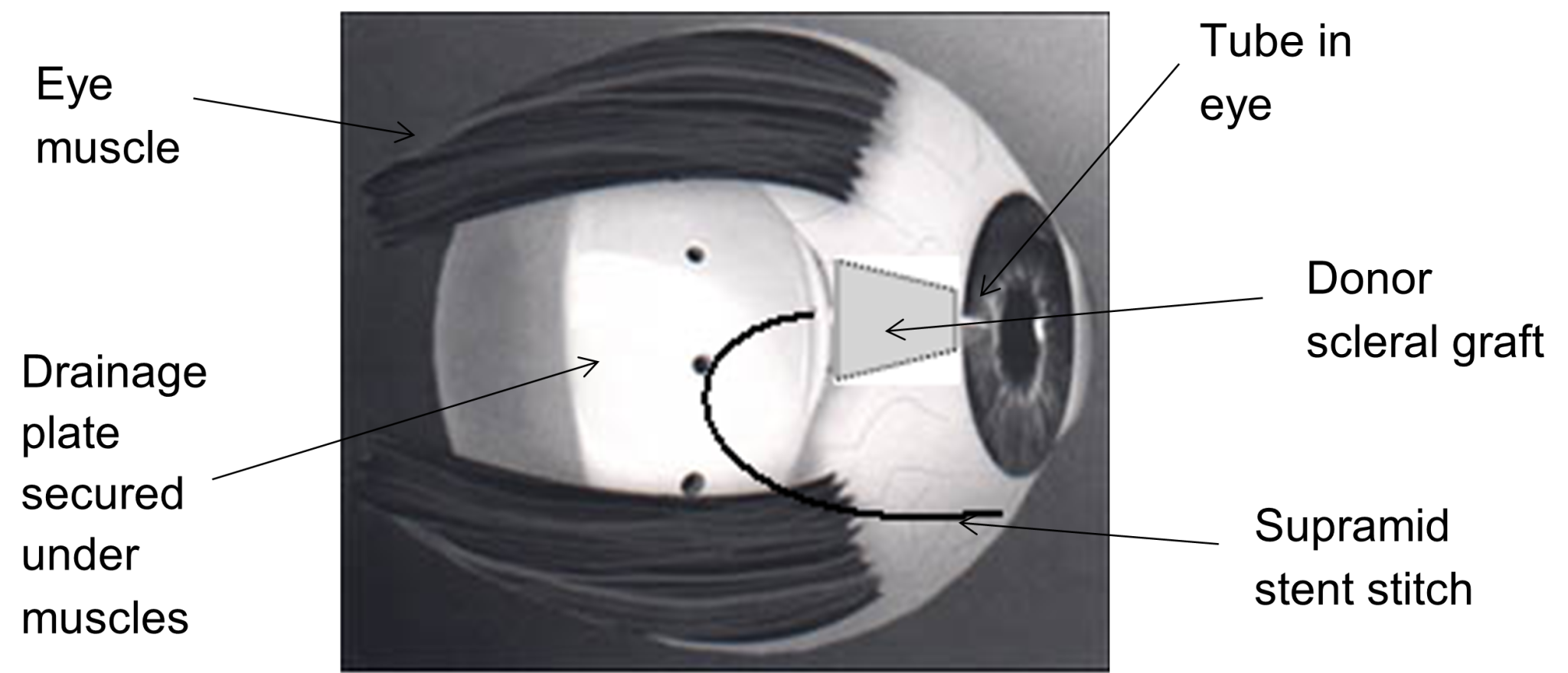 Glaucoma drainage surgery Baerveldt tube-shunt implant - The Dudley ...