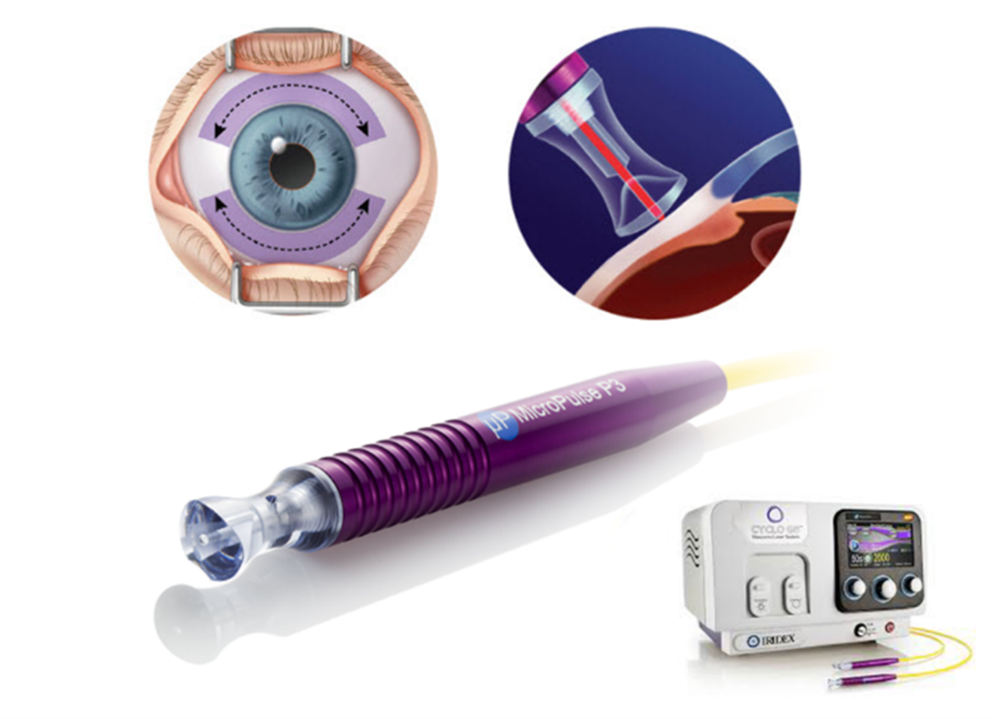 Cyclodiode laser treatment for glaucoma - The Dudley Group NHS ...