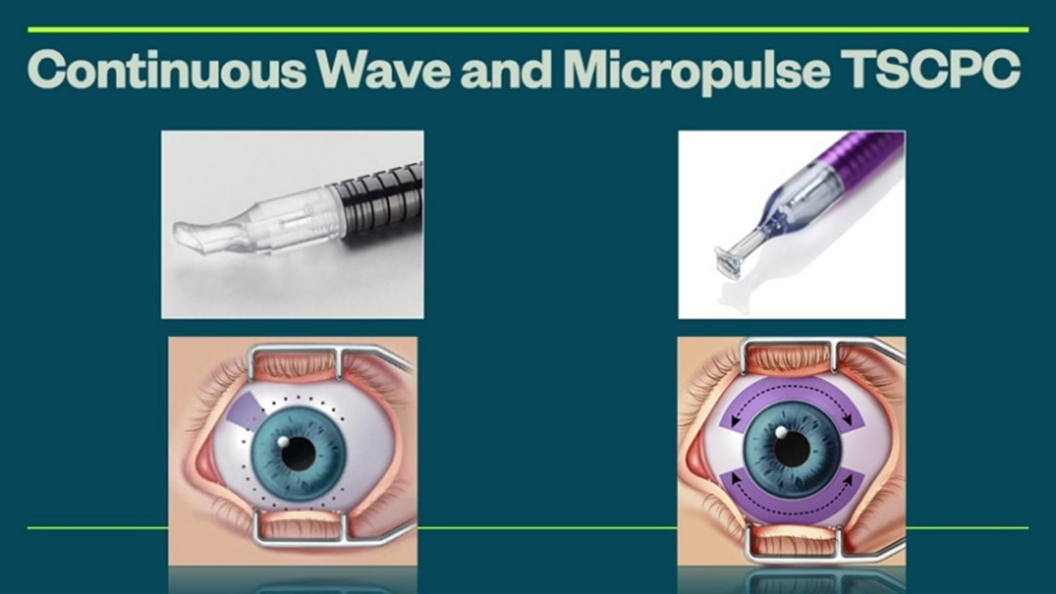 Cyclodiode laser treatment for glaucoma - The Dudley Group NHS ...