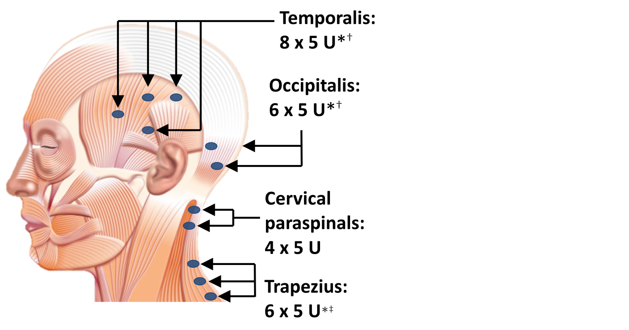 Botox for chronic migraine - The Dudley Group NHS Foundation Trust